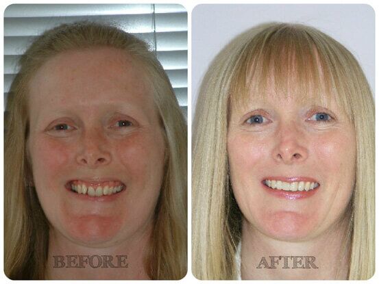 overbite correction uk nhs